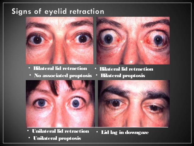 Thyroid eye diseases | PPT | Thyroid Disorders | Endocrine and ...