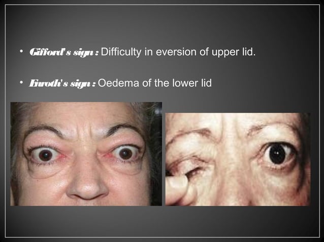 Thyroid eye diseases | PPT | Thyroid Disorders | Endocrine and ...
