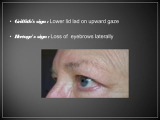 Thyroid eye diseases | PPT