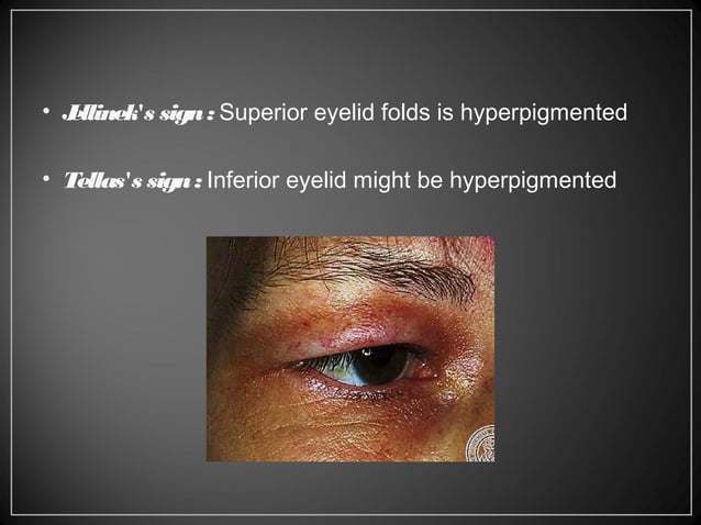 Thyroid eye diseases | PPT | Thyroid Disorders | Endocrine and ...