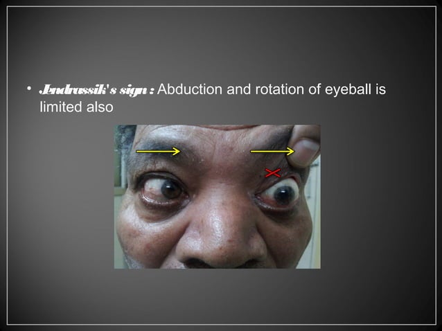 Thyroid eye diseases | PPT | Thyroid Disorders | Endocrine and ...