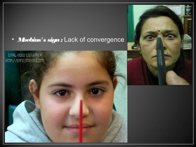 Thyroid eye diseases | PPT | Thyroid Disorders | Endocrine and ...