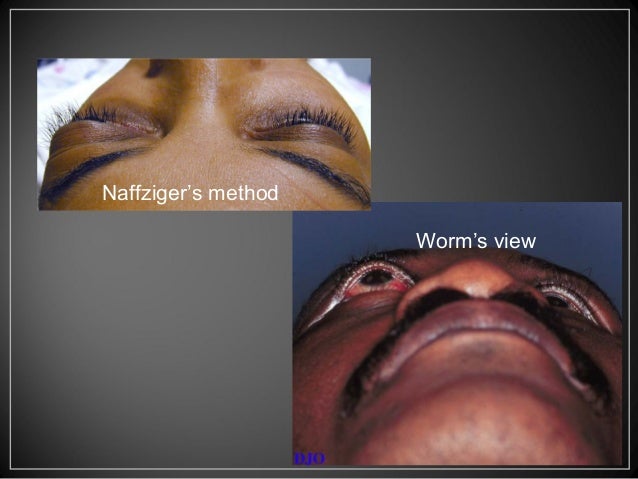 Thyroid eye diseases