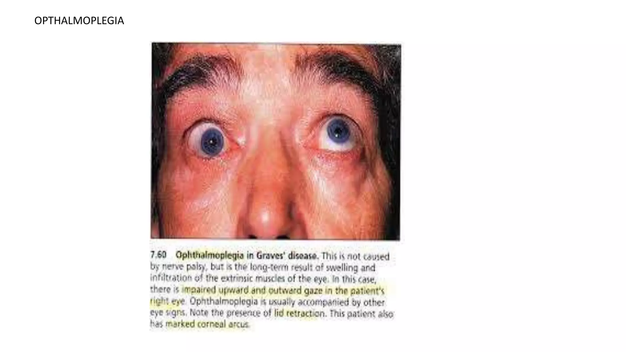 Thyroid eye signs slide | PPTX