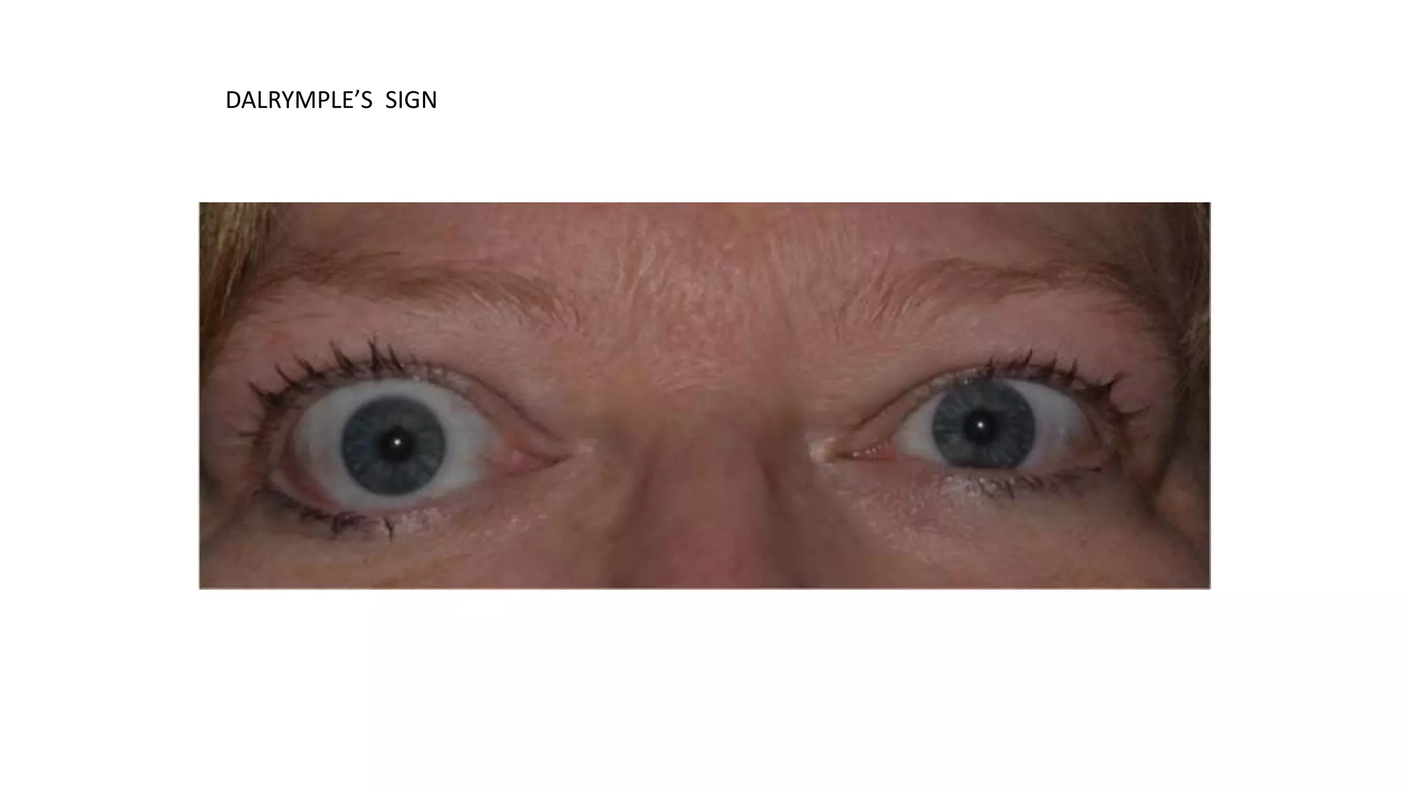 Thyroid eye signs slide | PPTX