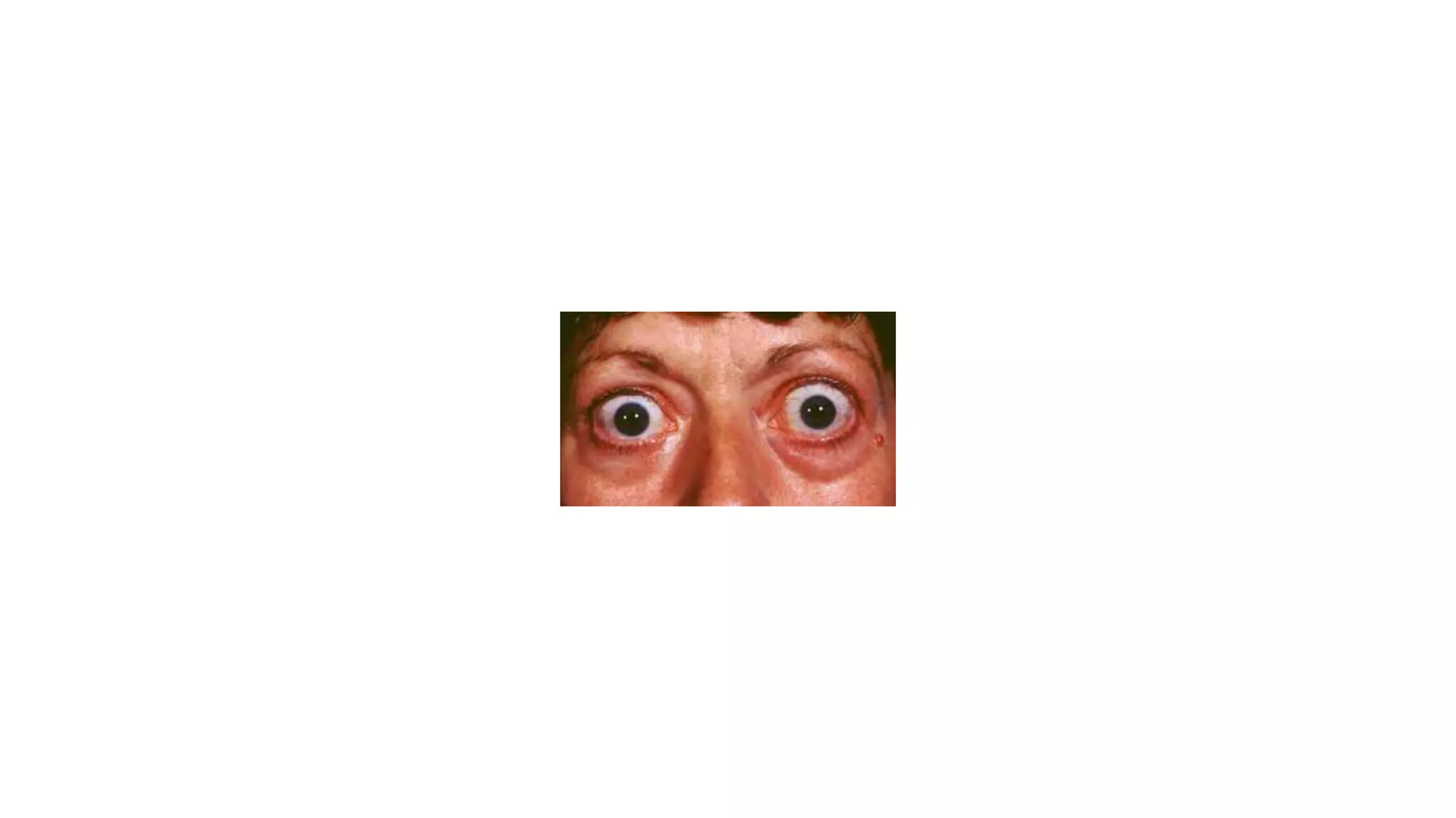 Thyroid eye signs slide | PPTX