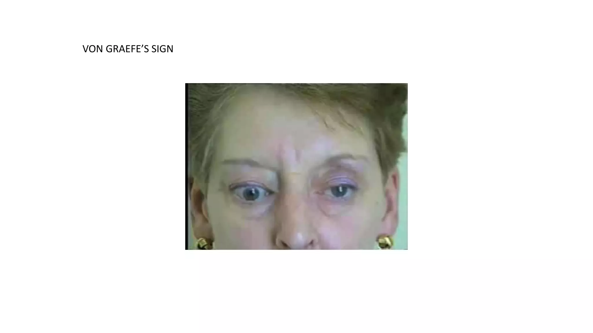 Thyroid eye signs slide | PPTX