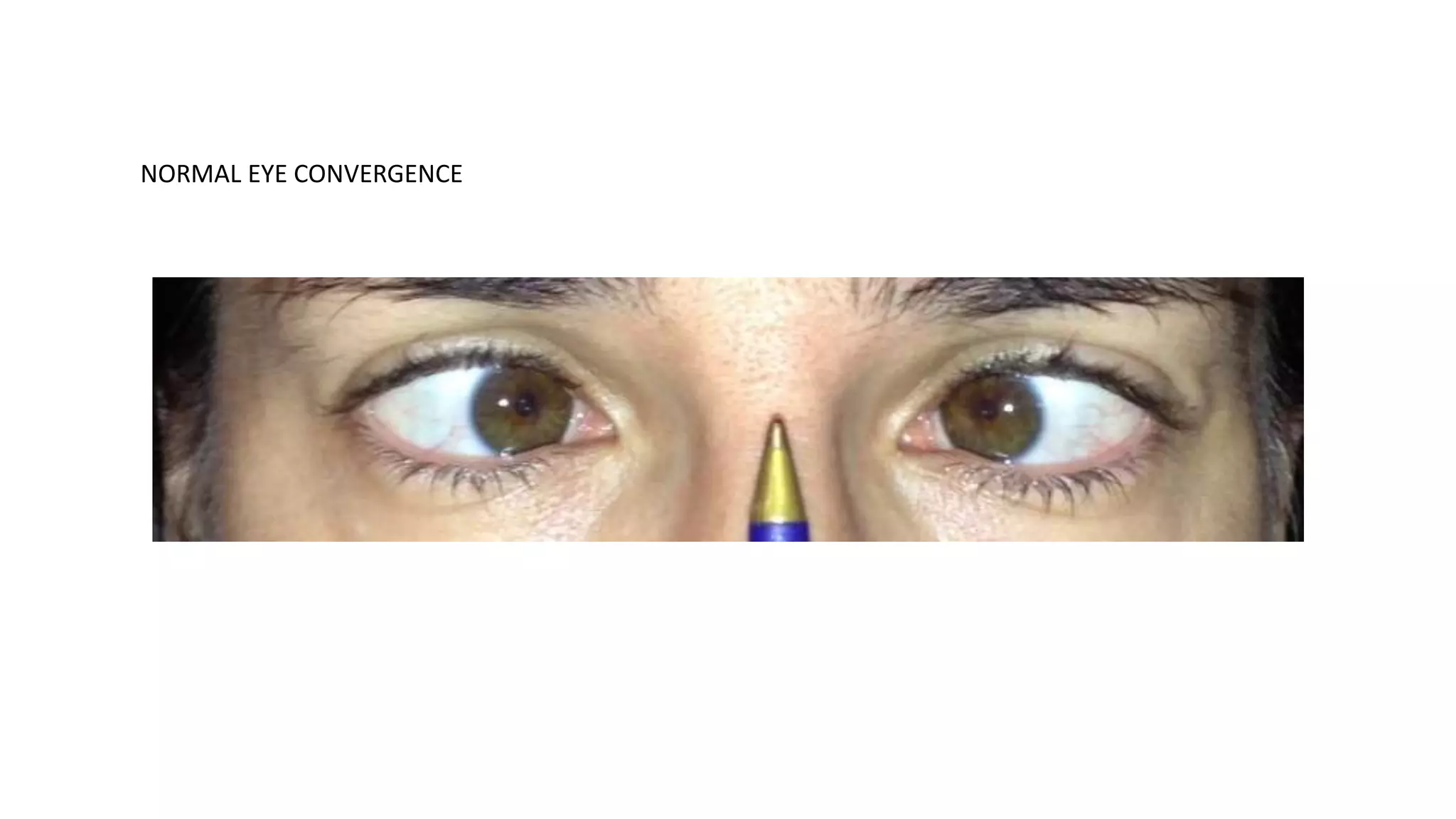 Thyroid eye signs slide | PPTX