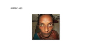 Thyroid eye signs slide | PPTX