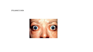 Thyroid eye signs slide | PPTX