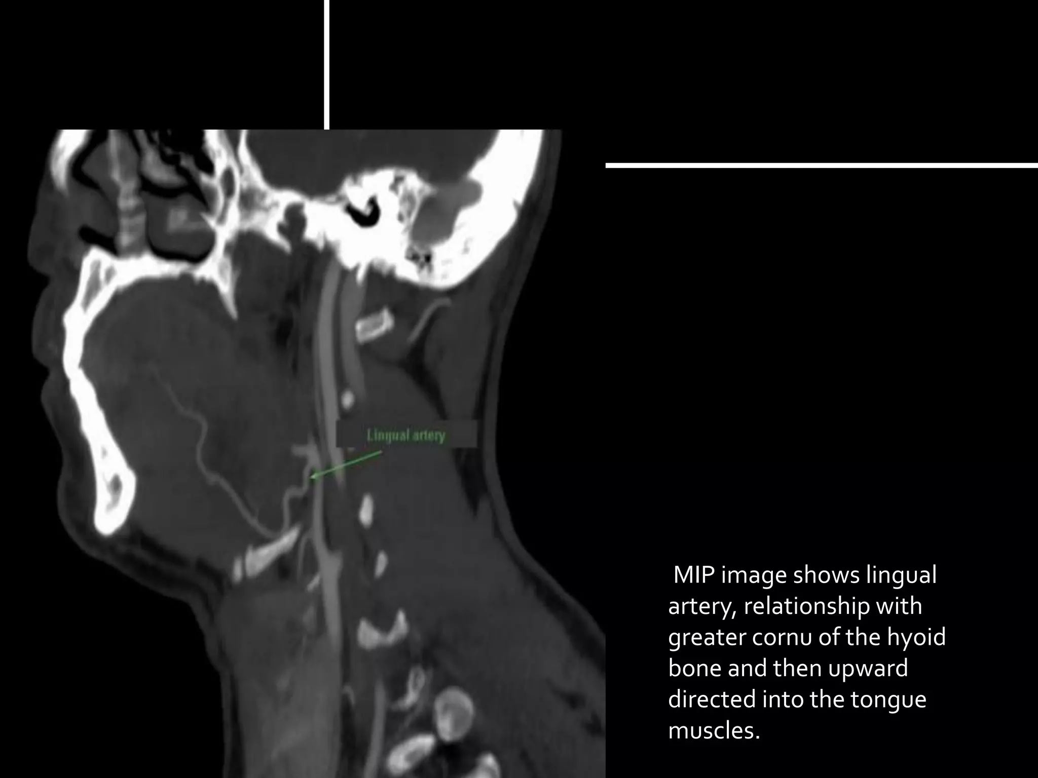 Thyroid, facial and lingual artery -- Anatomy and anastomosis | PPTX