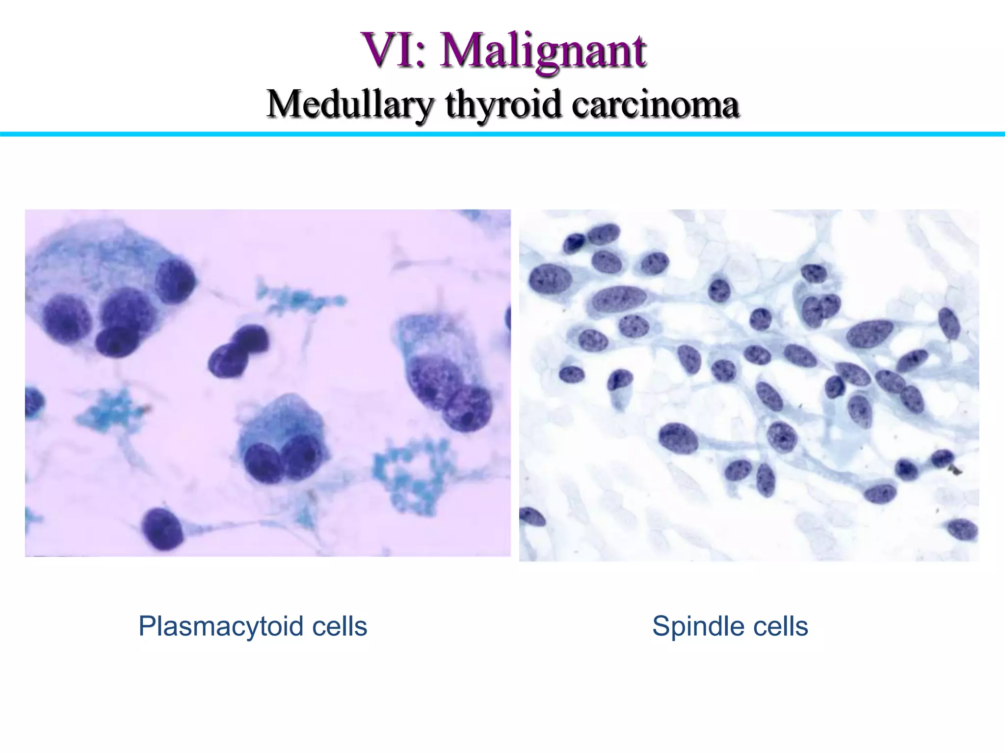 Thyroid Fna,bethesda system | PPTX
