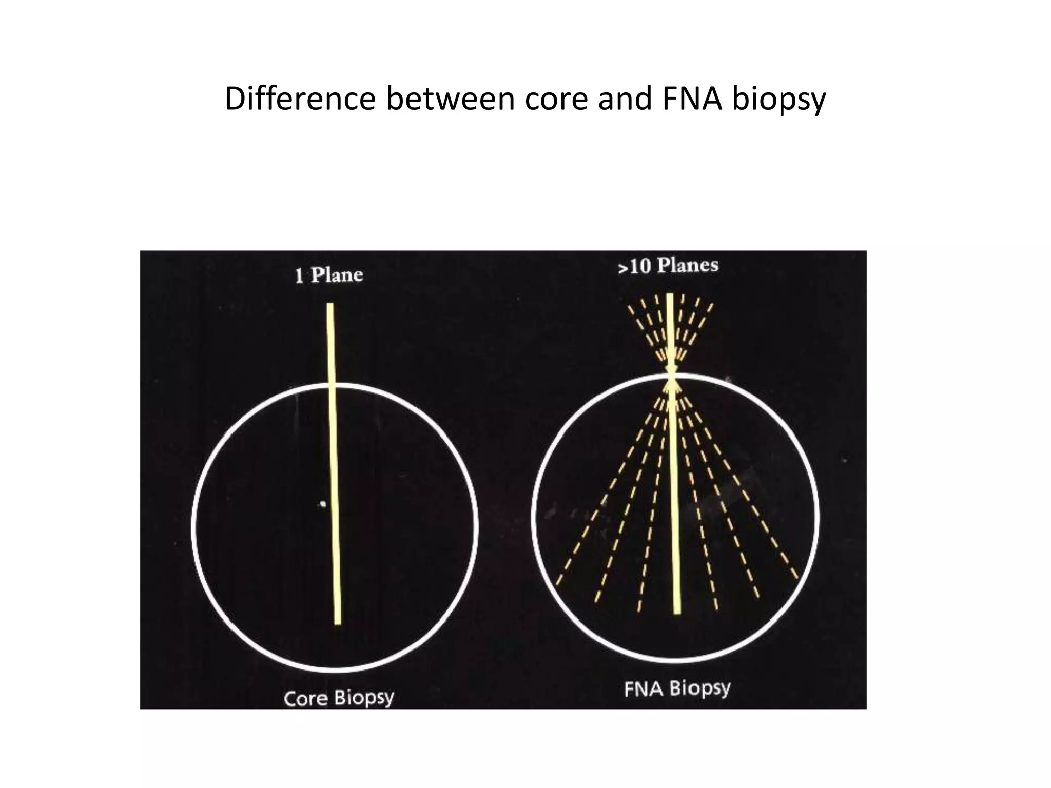 Thyroid Fna,bethesda system | PPTX