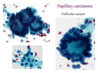 Thyroid Fna,bethesda system | PPTX