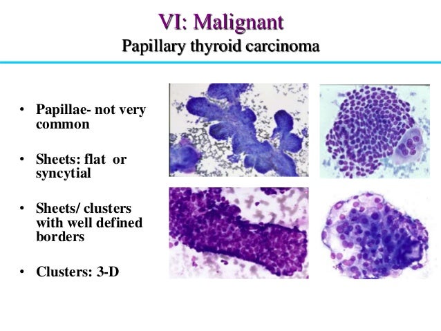 Thyroid Fna,bethesda system