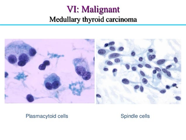 Thyroid Fna,bethesda system