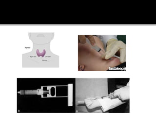 Thyroid FNAC | PPTX