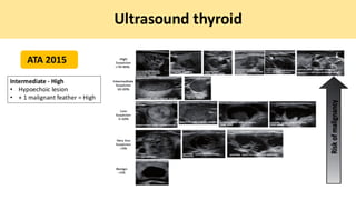 Thyroid for intern , basic approach to thyroid nodule | PDF
