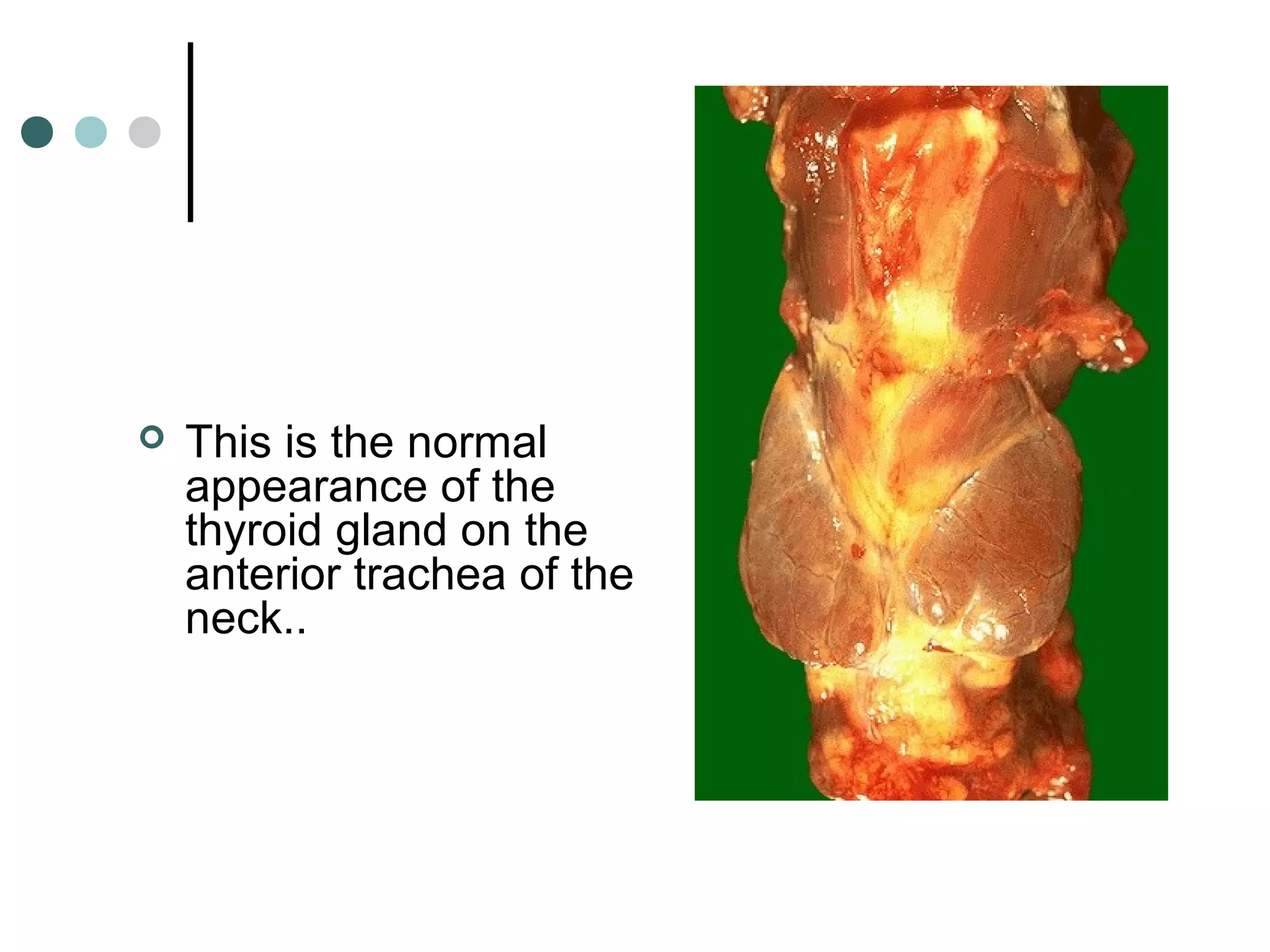 Thyroid gland anatomy, diseases , history and treatment | PPT