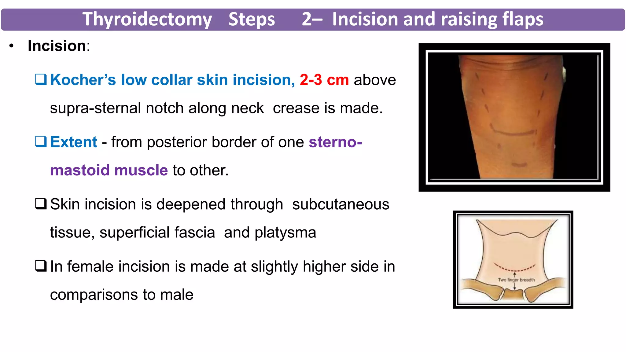 Thyroidectomy | PPTX