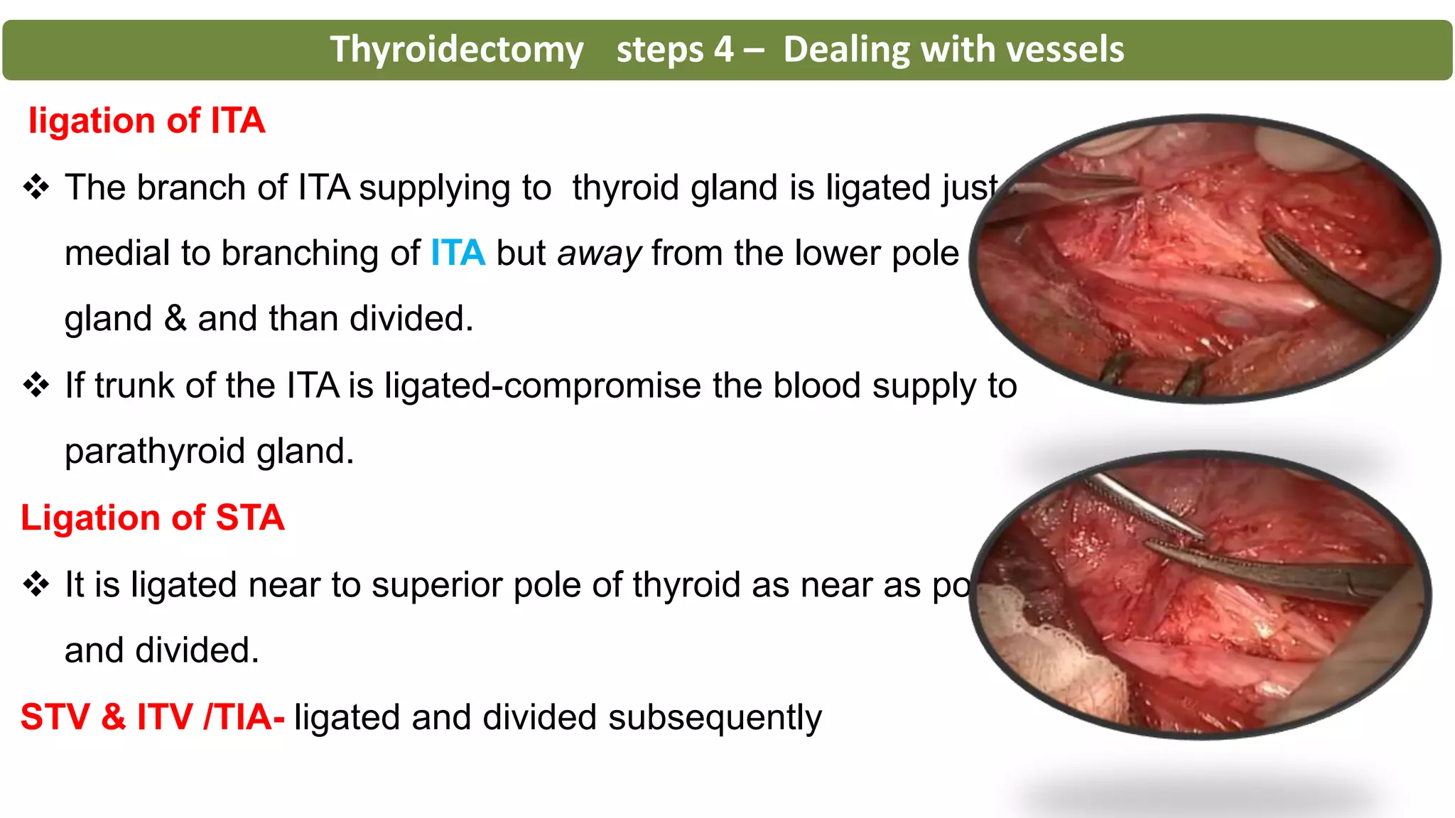Thyroidectomy | PPTX