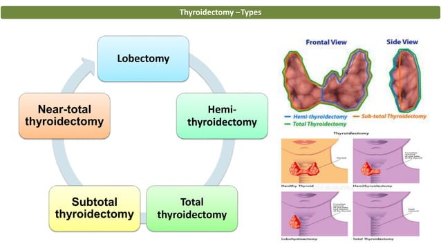 Thyroidectomy