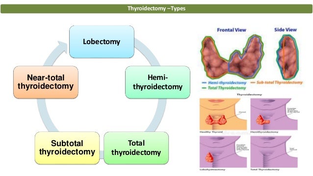 Thyroidectomy