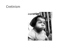 Thyroid gland | PPTX