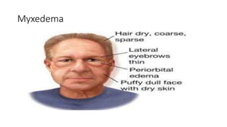 Thyroid gland | PPTX