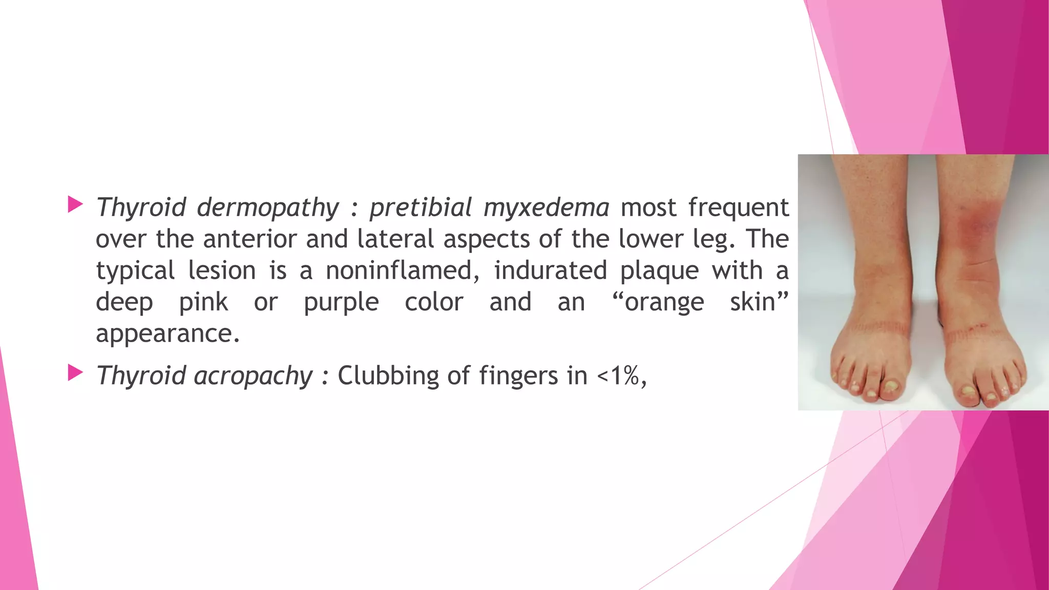 Thyroid gland | PPT
