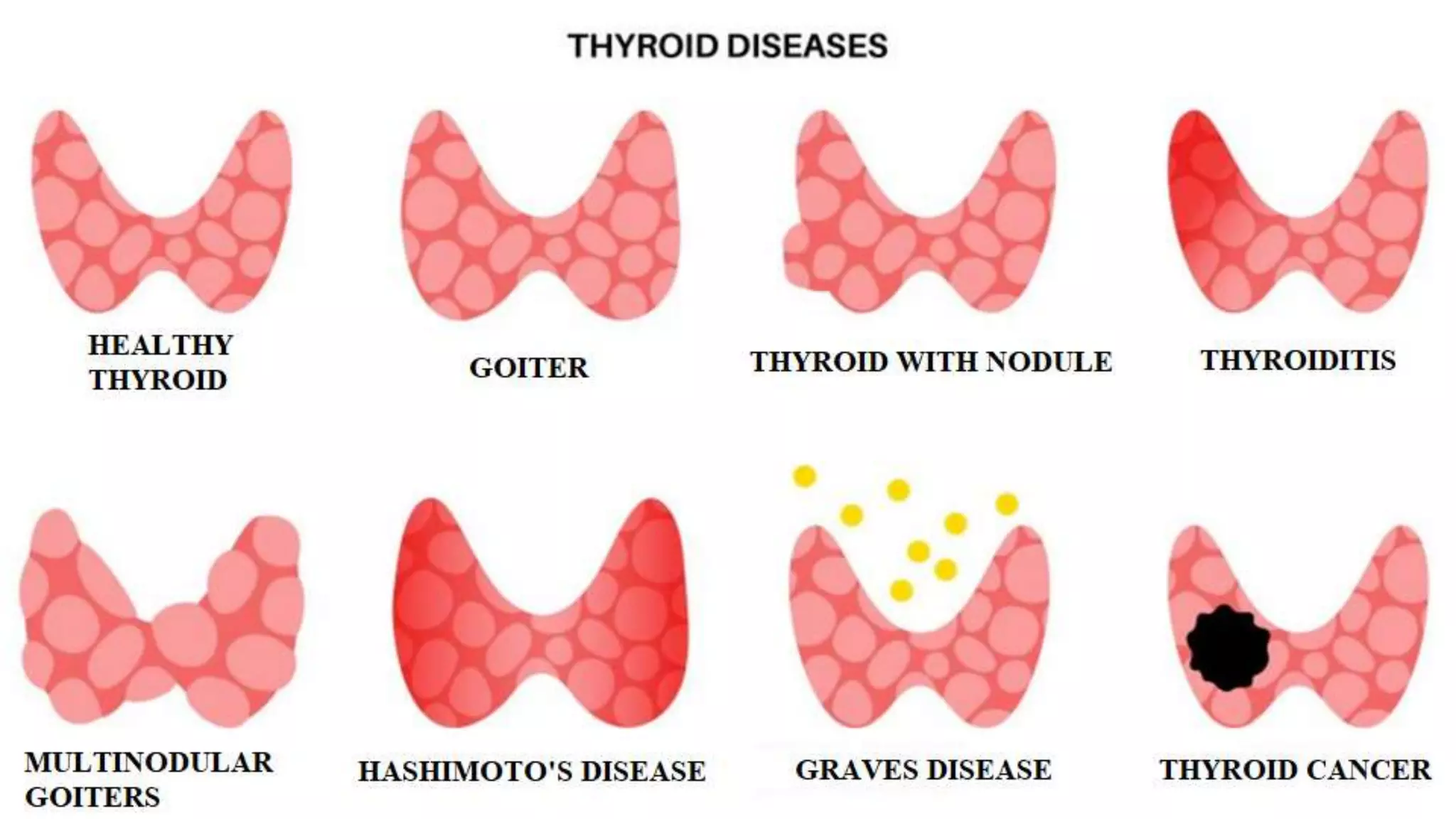 THYROID GLAND.pptx