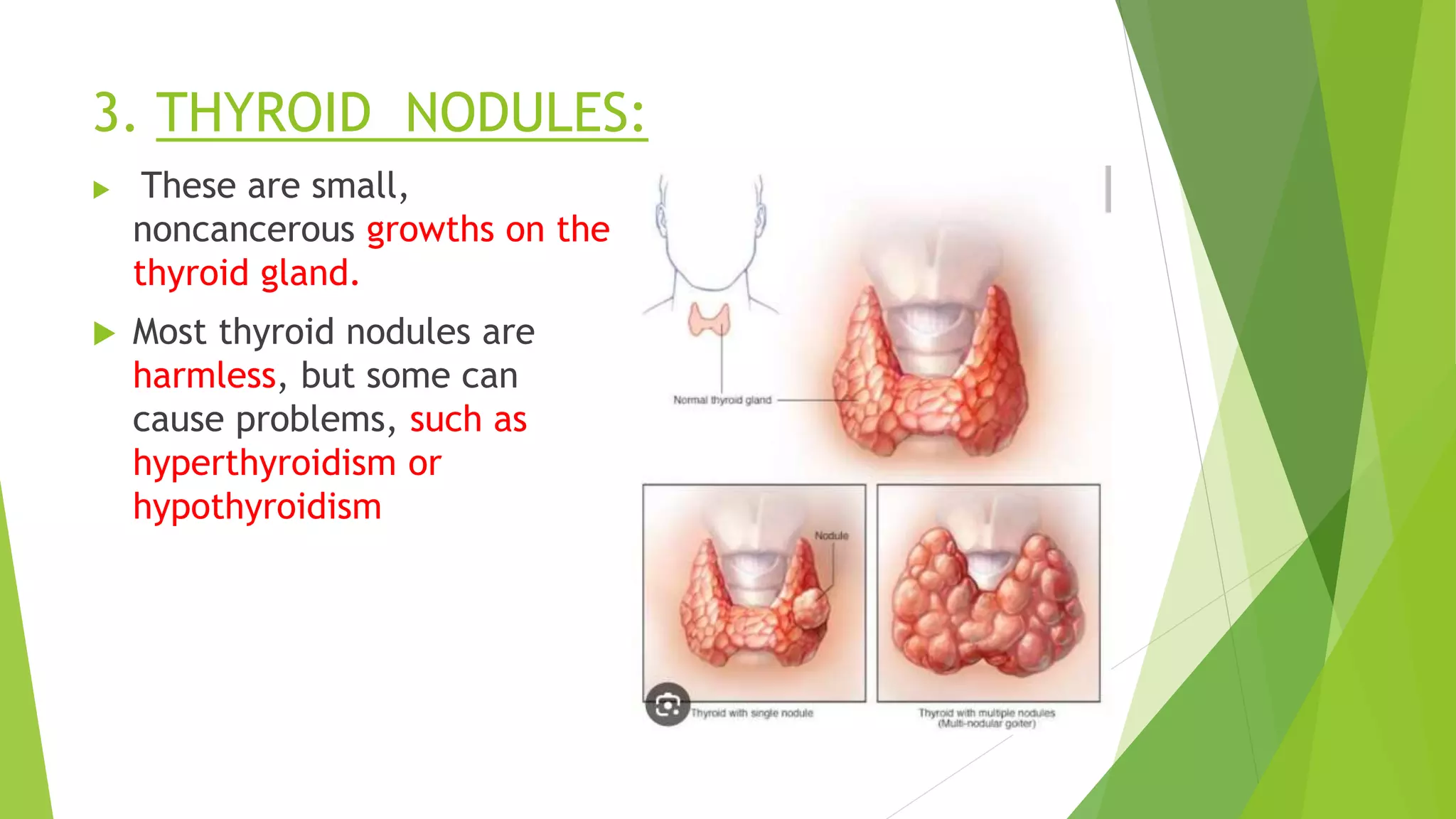 THYROID GLAND PRASENTATION BY A7 STARK 🐝 Less ☀️.pptx