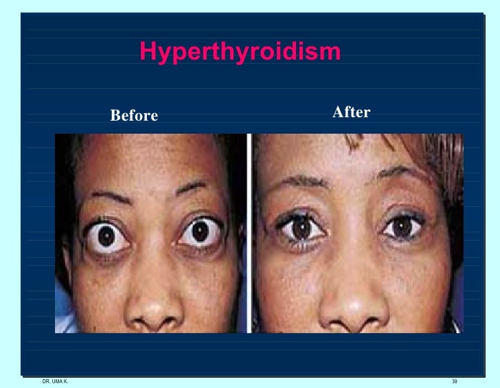 Thyroid Hormones 12 13