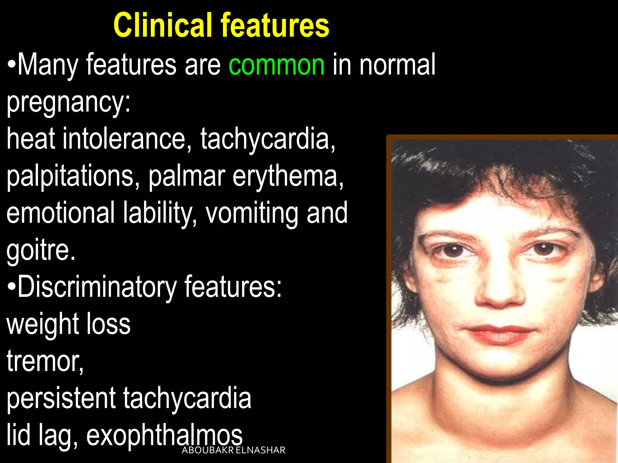 Hyperthyroidism During pregnancy | PDF