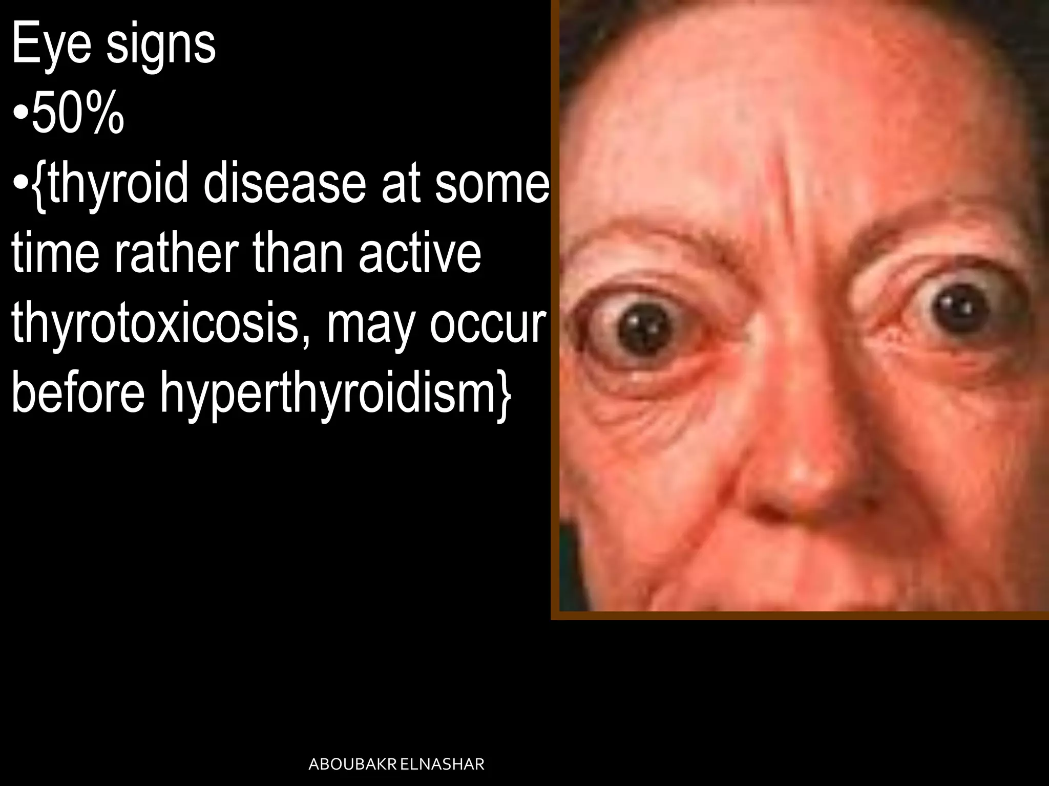 Hyperthyroidism During Pregnancy Ppt