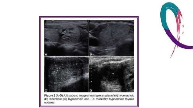 TIRADS SCORING : its Efficacy and Accuracy