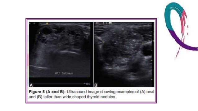 TIRADS SCORING : its Efficacy and Accuracy