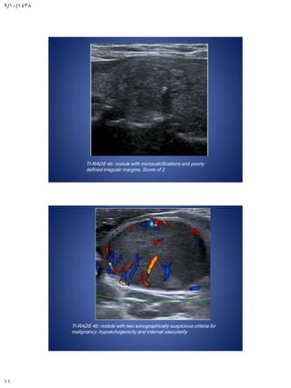 Thyroid image reporting and data system | PDF | Thyroid Disorders ...