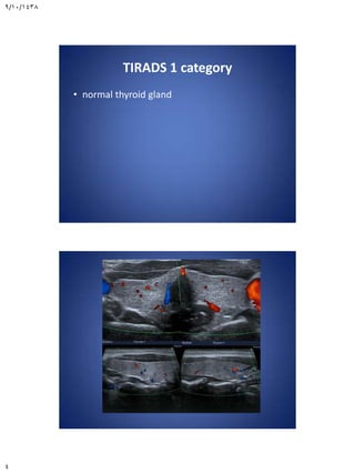 Thyroid image reporting and data system | PDF | Thyroid Disorders ...