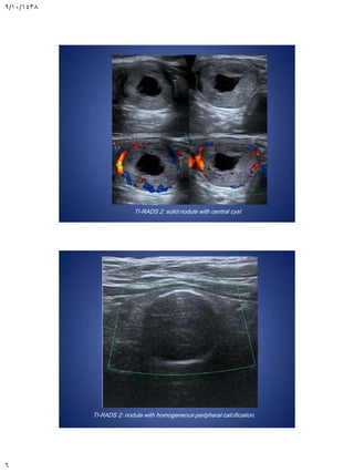 Thyroid image reporting and data system | PDF