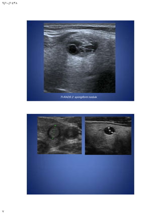 Thyroid image reporting and data system | PDF | Thyroid Disorders ...