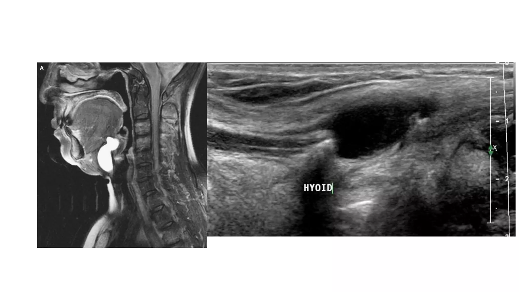 Thyroid imaging | PPTX