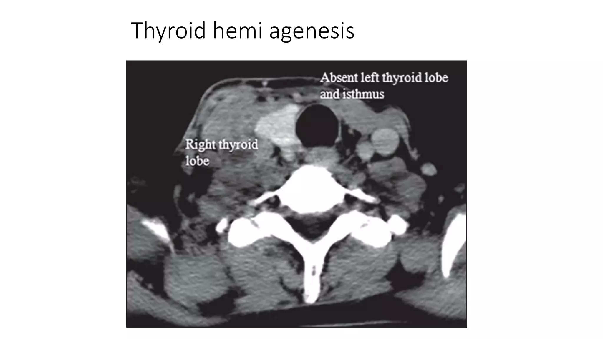 Thyroid imaging | PPTX