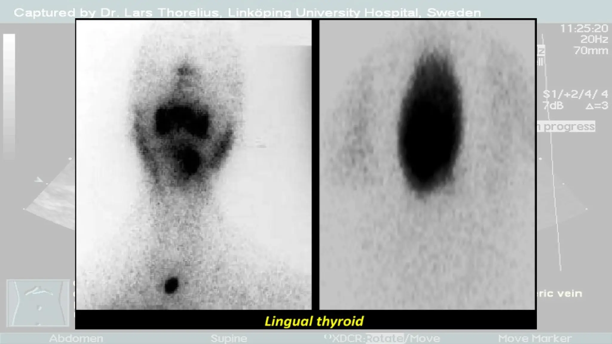 THYROID IMAGING for modern tbyroid diseases | PPTX