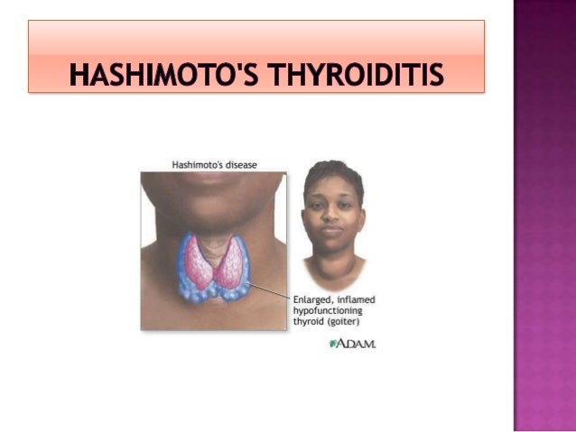 Thyroiditis