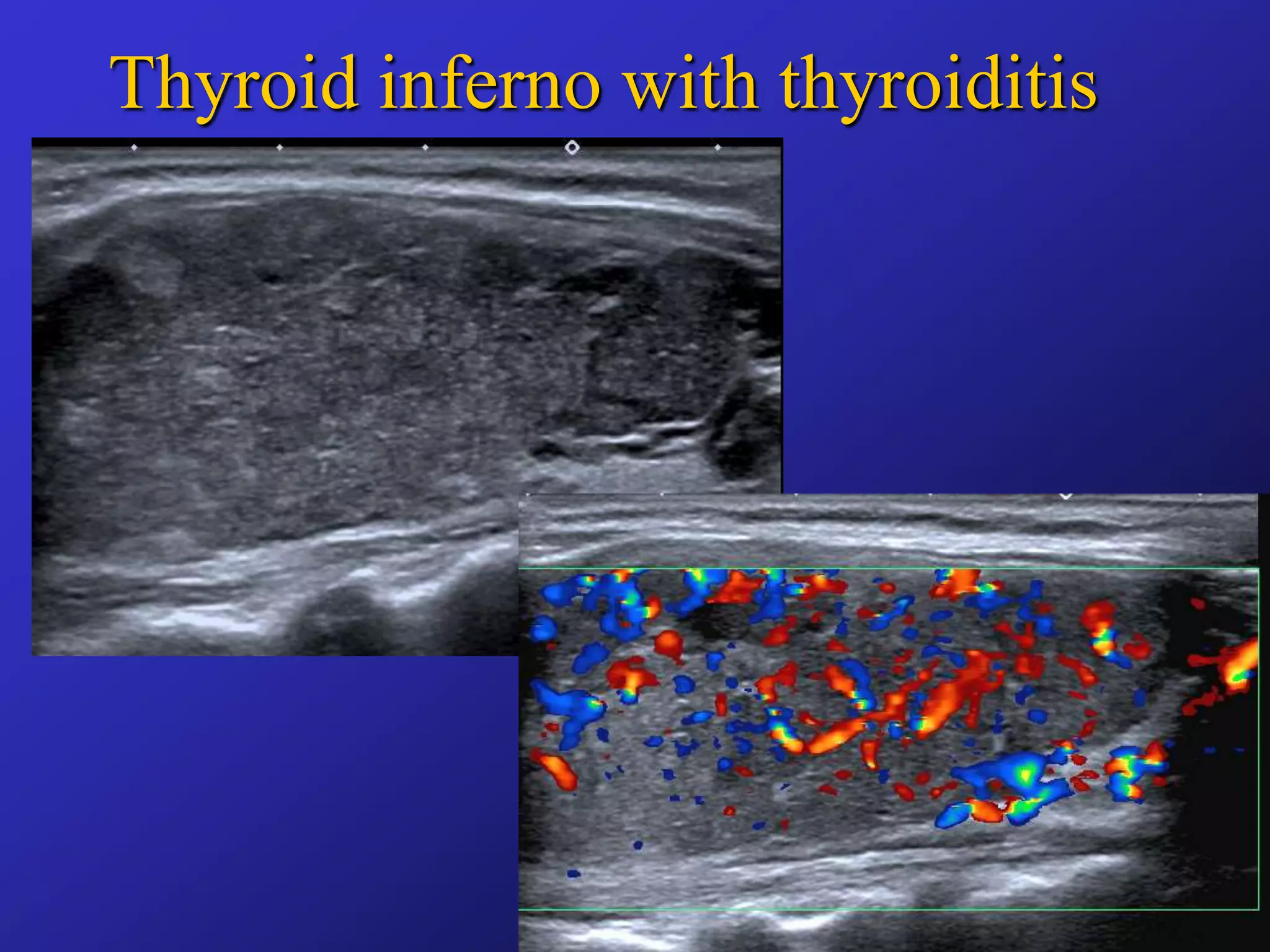 Thyroiditis | PPTX