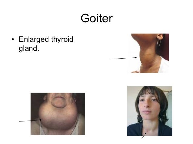 thyroid