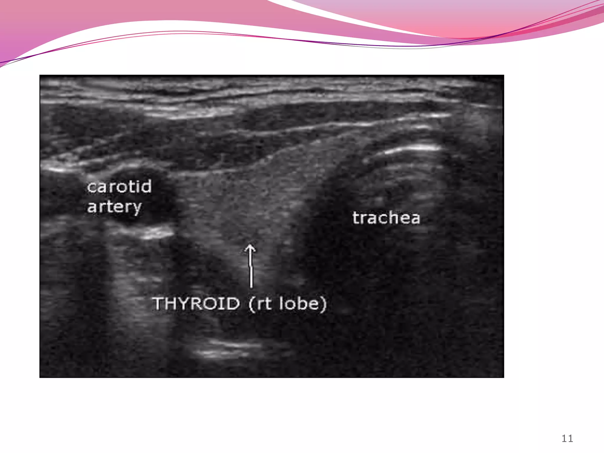 DR RAJ BUMIYA'S THYROID LESIONS USG - ULTRASONOGRAPHY | PPTX