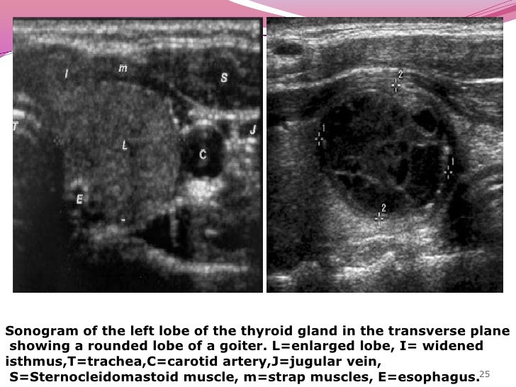 DR RAJ BUMIYA'S THYROID LESIONS USG - ULTRASONOGRAPHY
