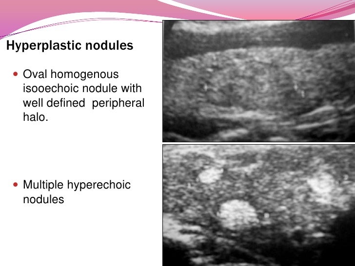 DR RAJ BUMIYA'S THYROID LESIONS USG - ULTRASONOGRAPHY